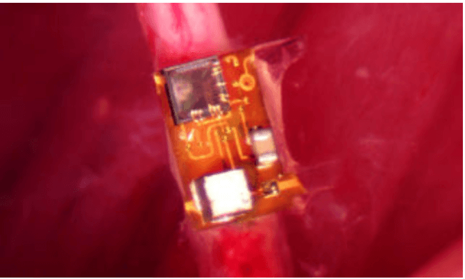 Implanted Ultrasonic Neural Dust Sensors - FloMedical